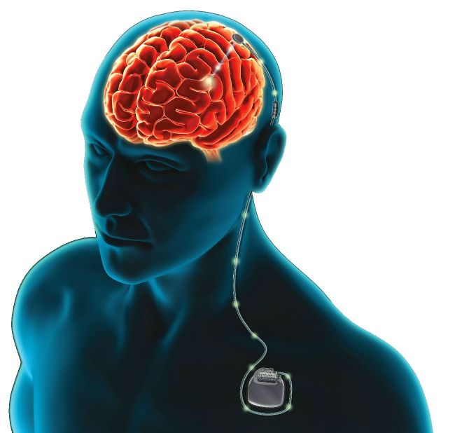 WHAT IS DEEP BRAIN STIMULATION? | How It Works Issue 209