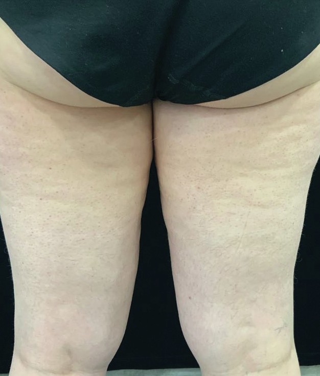 INJECTABLE CELLULITE TREATMENT | July/August 2024 - Aesthetic Medicine ...